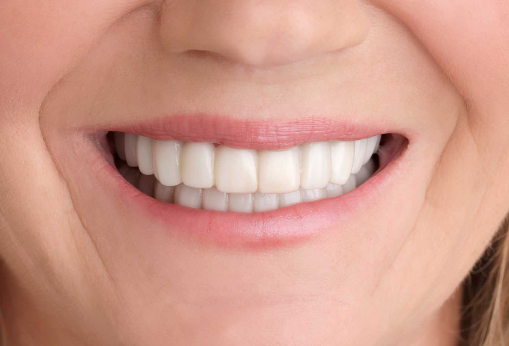 Snap-On Smile - Less-expensive alternative to full mouth reconstruction
